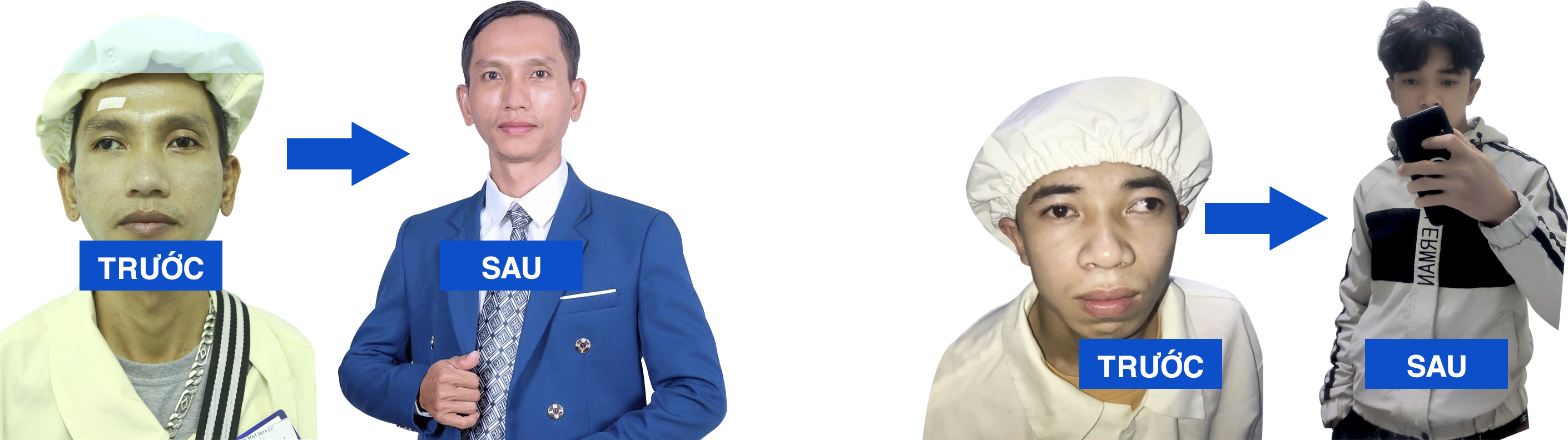 60 năm sống với đôi mắt lác: “Tôi ước gì mình dám thay đổi sớm...