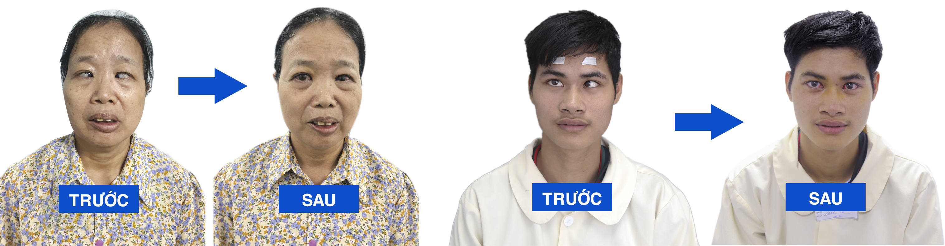 60 năm sống với đôi mắt lác: “Tôi ước gì mình dám thay đổi sớm...