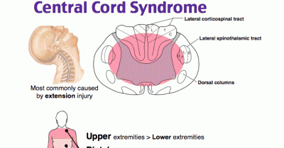 Bệnh Central Cord Syndrome: Nguyên nhân, biến chứng và cách điều...