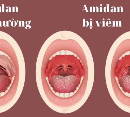 6 Bác sĩ chuyên điều trị viêm amidan hàng đầu tại TP.HCM